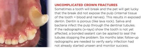 Uncomplicated Crown Fractures